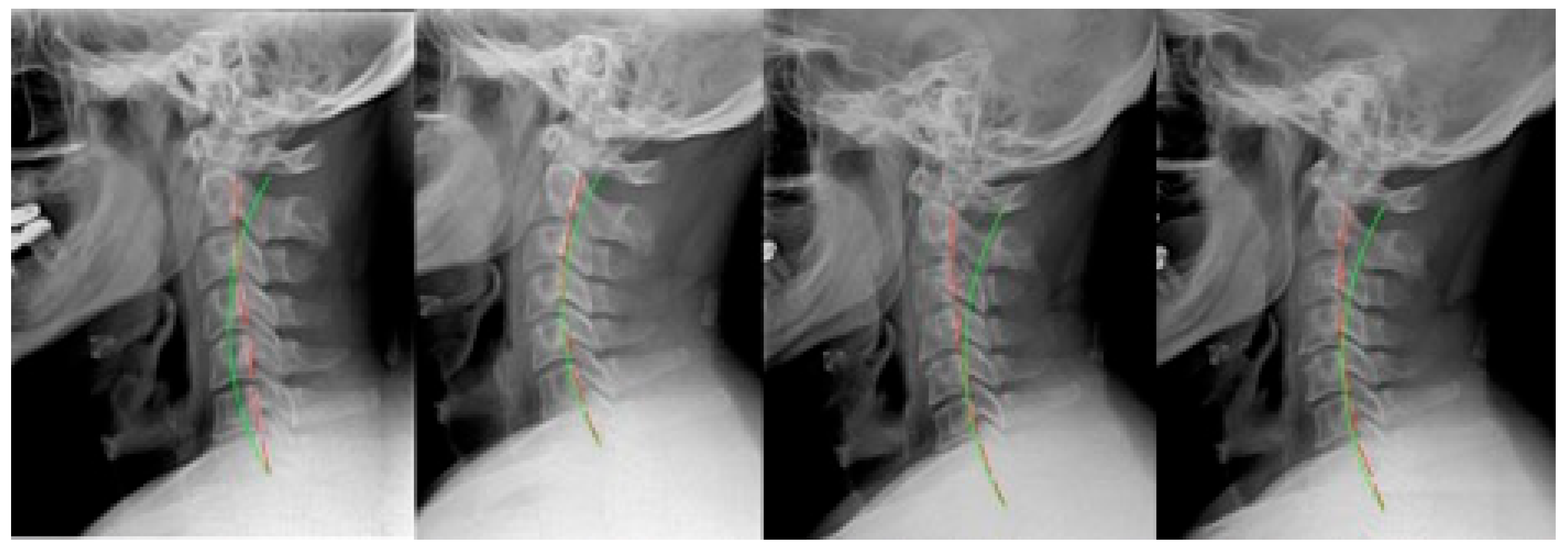 Positive Outcomes Following Cervical Acceleration-Deceleration (CAD ...