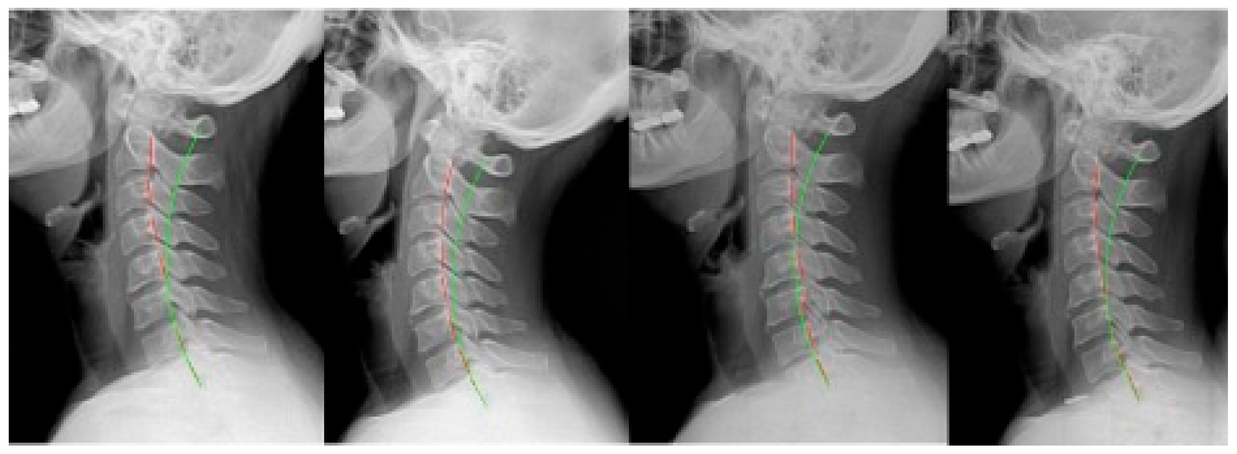 Positive Outcomes Following Cervical Acceleration-Deceleration (CAD ...