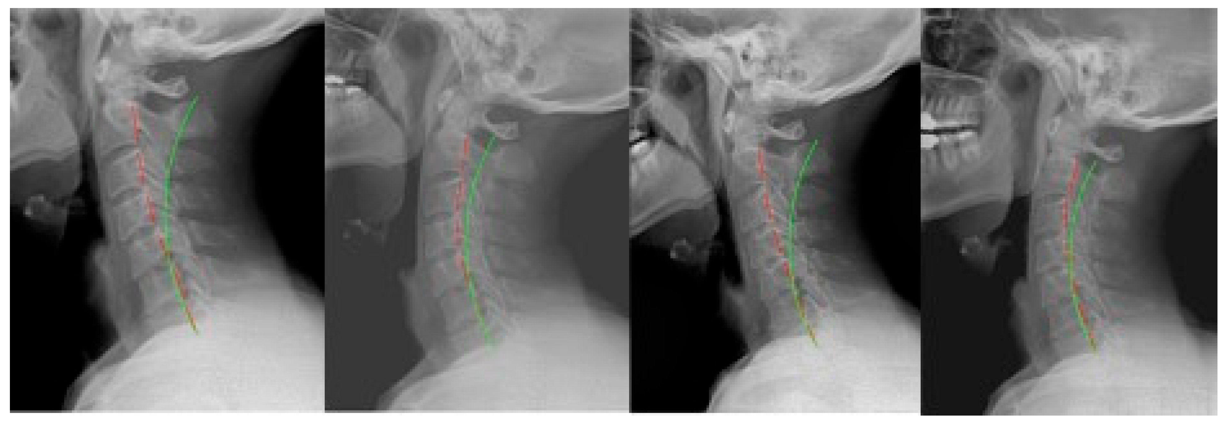 Positive Outcomes Following Cervical Acceleration-Deceleration (CAD ...