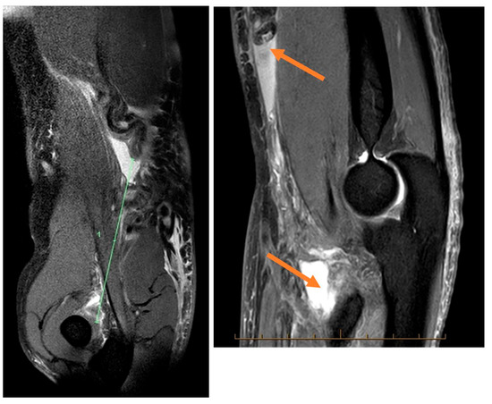Comparative Analysis of Surgical Approaches for Distal Biceps Tendon ...