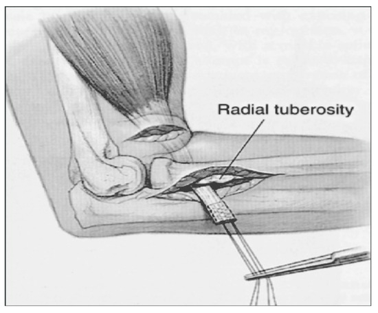 JCM | Free Full-Text | Comparative Analysis of Surgical Approaches for ...