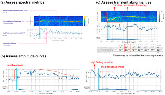 Gastric Alimetry® Test Interpretation in Gastroduodenal Disorders ...