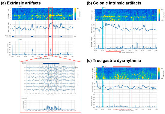 Gastric Alimetry® Test Interpretation in Gastroduodenal Disorders ...