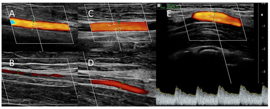 Radial Artery Deviation and Reimplantation (RADAR) to Accelerate the ...