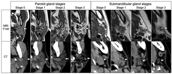 Three Signs to Help Detect Sjögren’s Syndrome: Incidental Findings on ...