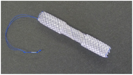 Usefulness of Intraductal Placement of a Dumbbell-Shaped Fully Covered ...