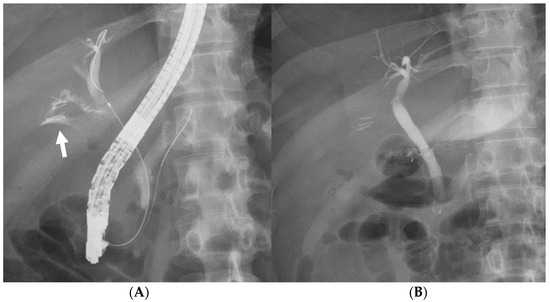 Usefulness of Intraductal Placement of a Dumbbell-Shaped Fully Covered ...
