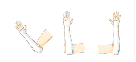 Comparative Analysis of Treatment Outcomes: Modified Ulnar Gutter Slab ...
