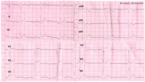 Twelve-Lead ECG, Holter Monitoring Parameters, and Genetic Testing in ...