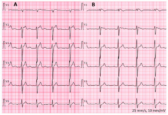 Twelve-Lead ECG, Holter Monitoring Parameters, and Genetic Testing in ...