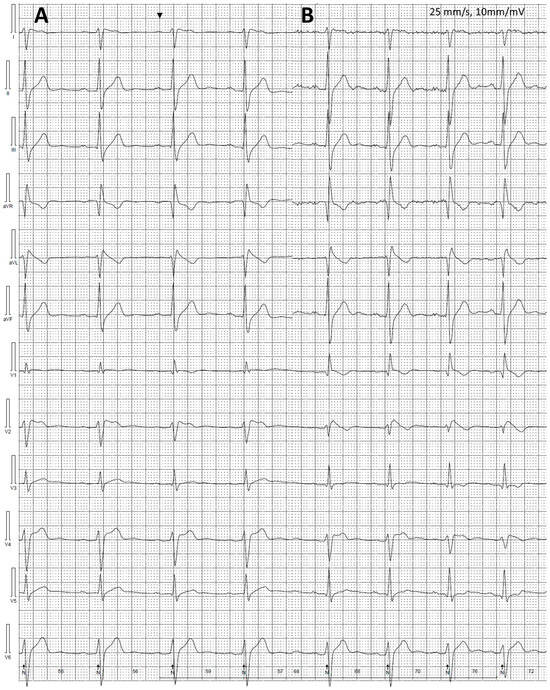 Twelve-Lead ECG, Holter Monitoring Parameters, and Genetic Testing in ...