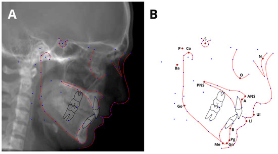 Correlation Analysis of Nasal Septum Deviation and Results of AI-Driven ...