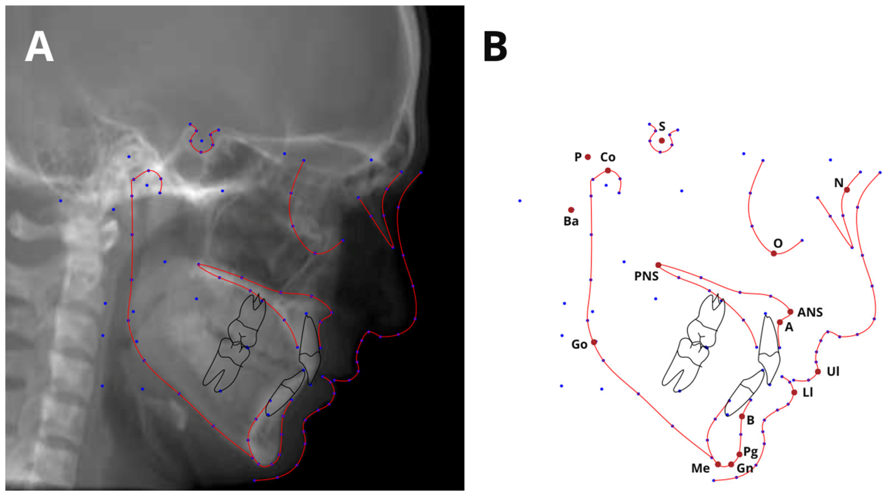 Correlation Analysis of Nasal Septum Deviation and Results of AI-Driven Automated 3D ...