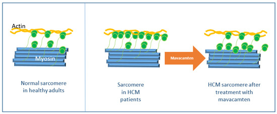 Alcohol Septal Ablation or Mavacamten for Obstructive Hypertrophic ...