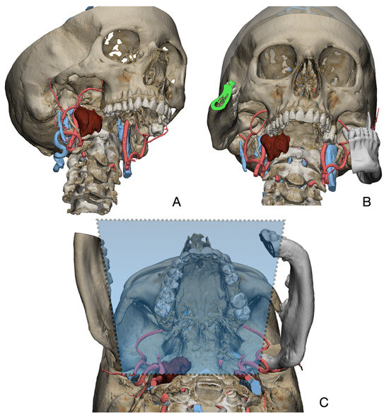 Exploring Deep Cervical Compartments in Head and Neck Surgical Oncology ...