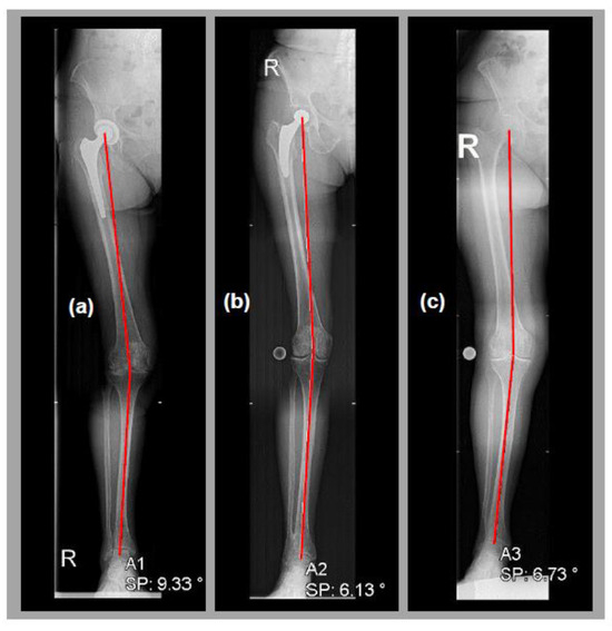 Stem Design in Total Hip Arthroplasty Influences Ipsilateral Knee ...