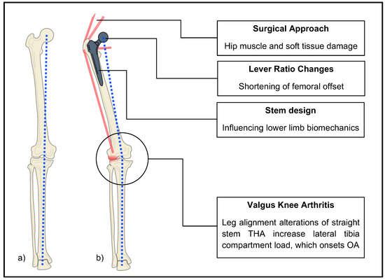 Stem Design in Total Hip Arthroplasty Influences Ipsilateral Knee ...
