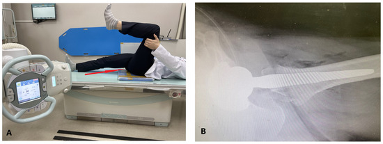 Could We Expect Postoperative Cup Anteversion after Total Hip ...