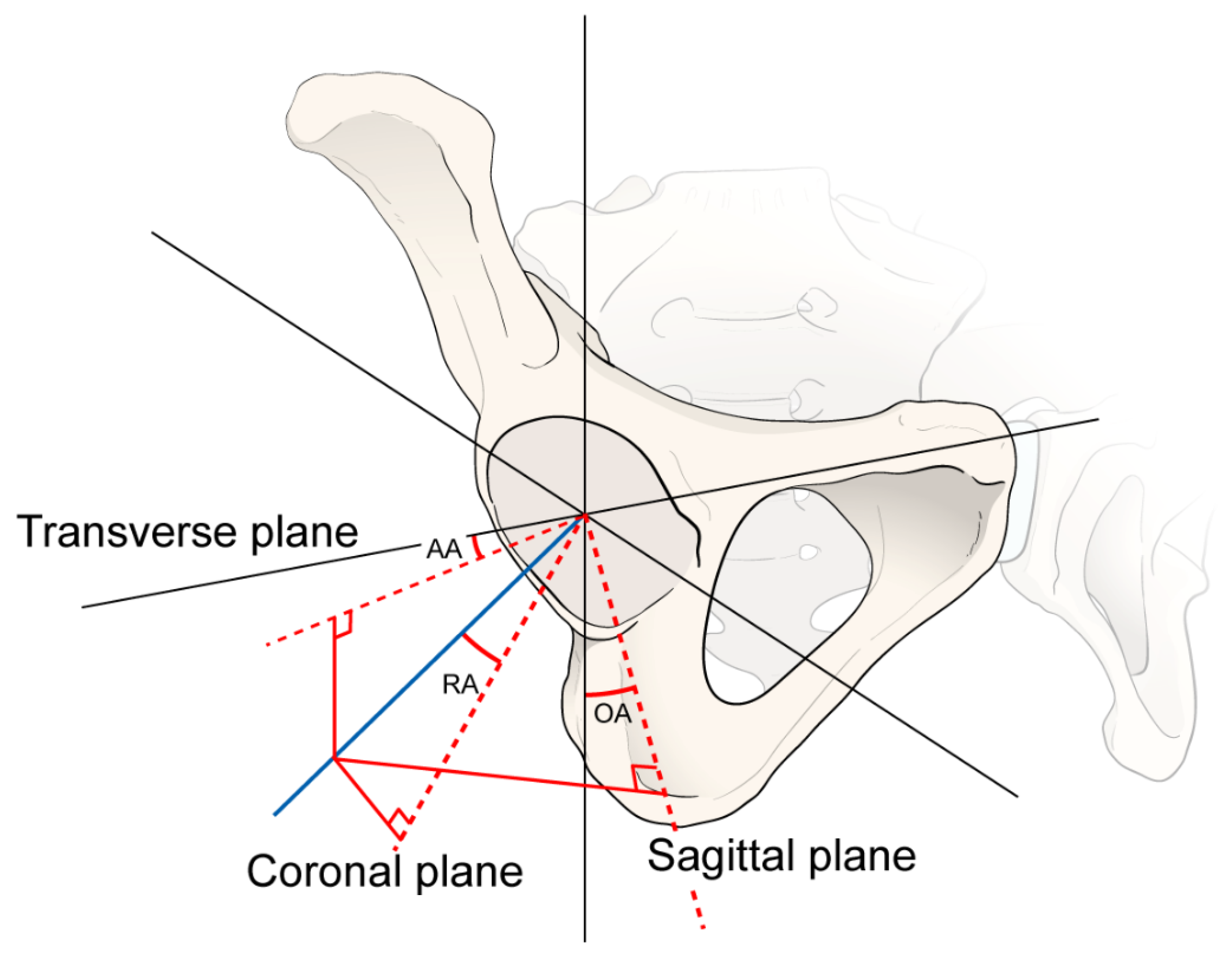 Could We Expect Postoperative Cup Anteversion after Total Hip ...