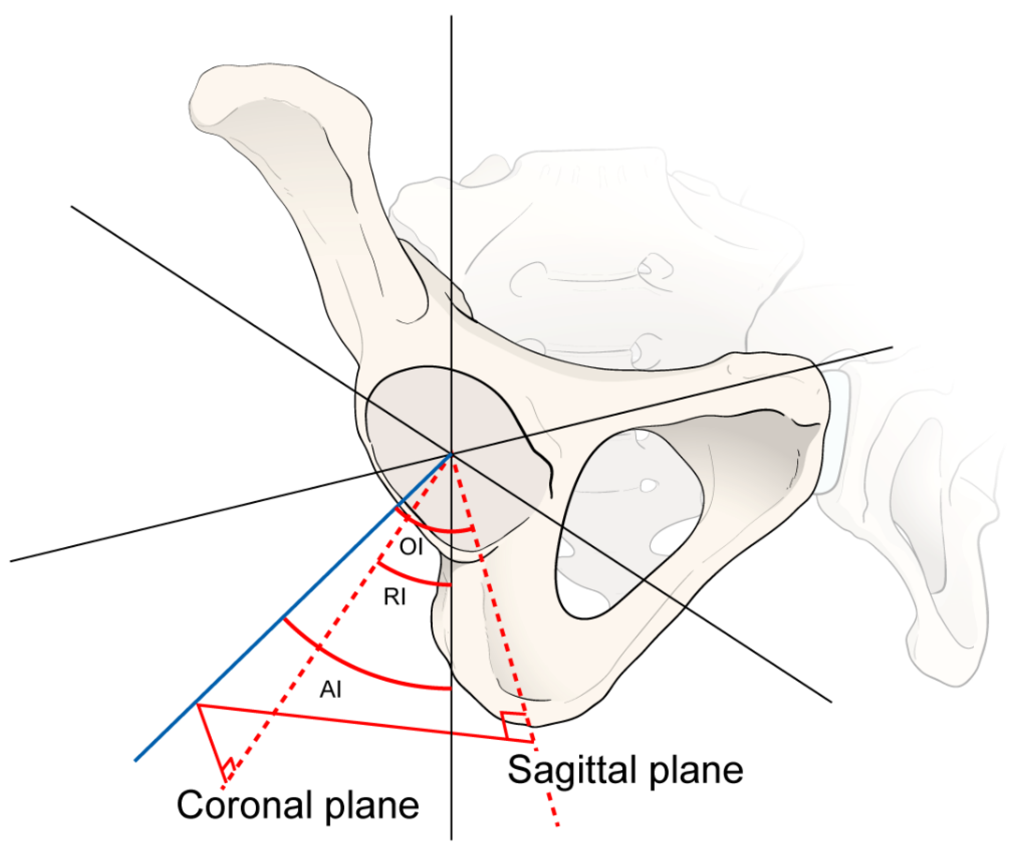 Could We Expect Postoperative Cup Anteversion after Total Hip ...
