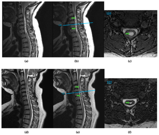 Developing Semiautomated Methods to Measure Pre- and Postoperative ...