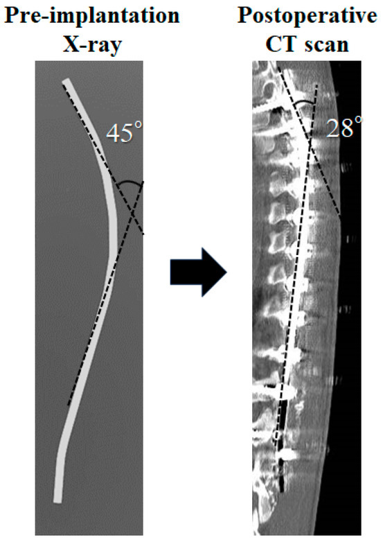 Rod Rotation with Outrigger Is Substantial for Correcting Apical ...