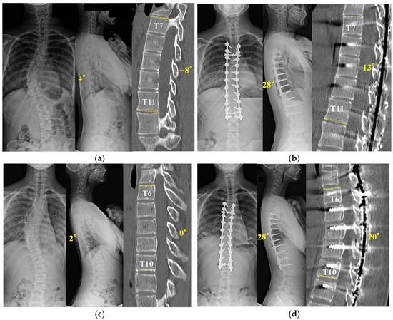 Rod Rotation with Outrigger Is Substantial for Correcting Apical ...