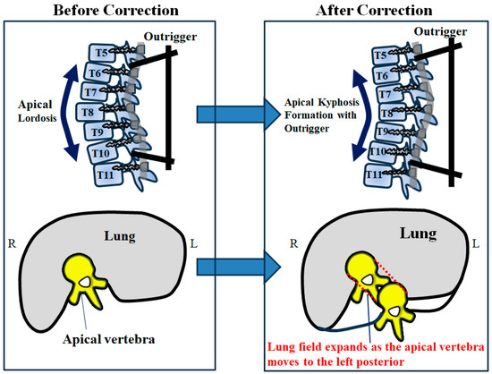 Rod Rotation with Outrigger Is Substantial for Correcting Apical ...