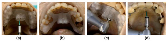 Accuracy of Palatal Orthodontic Mini-Implants Placed Using Fully Digital Planned Insertion ...