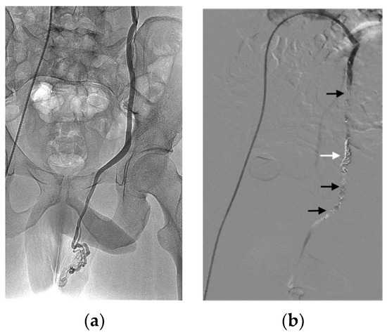 Amplatzer™ Vascular Plugs for Embolisation: A 10-Year Single-Centre ...