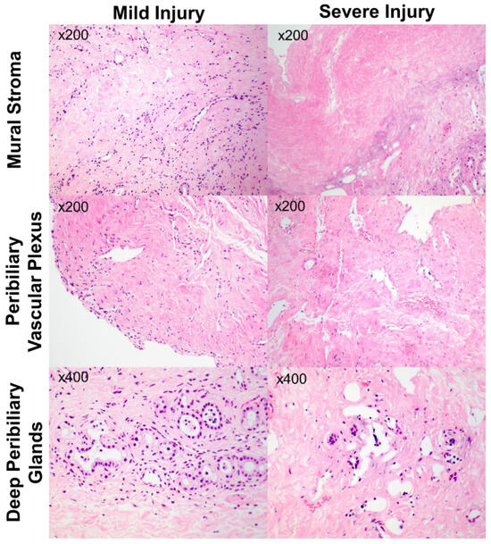Histological Assessment of the Bile Duct before Liver Transplantation ...