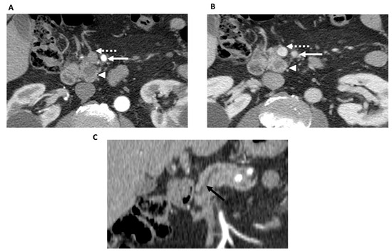 CT Imaging Assessment of Pancreatic Adenocarcinoma Resectability after ...