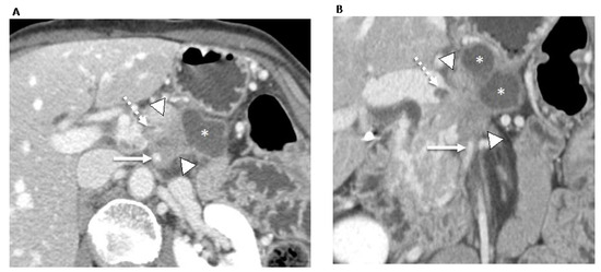 CT Imaging Assessment of Pancreatic Adenocarcinoma Resectability after ...