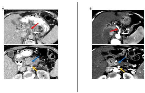 CT Imaging Assessment of Pancreatic Adenocarcinoma Resectability after ...