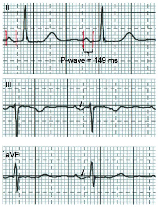 The Role of Electrocardiographic Markers for Predicting Atrial ...