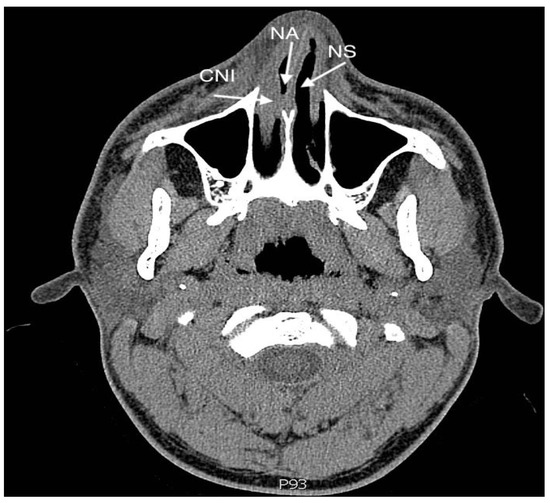 Intranasal Synechiae as Complications of Rhinosurgical Treatment—A ...