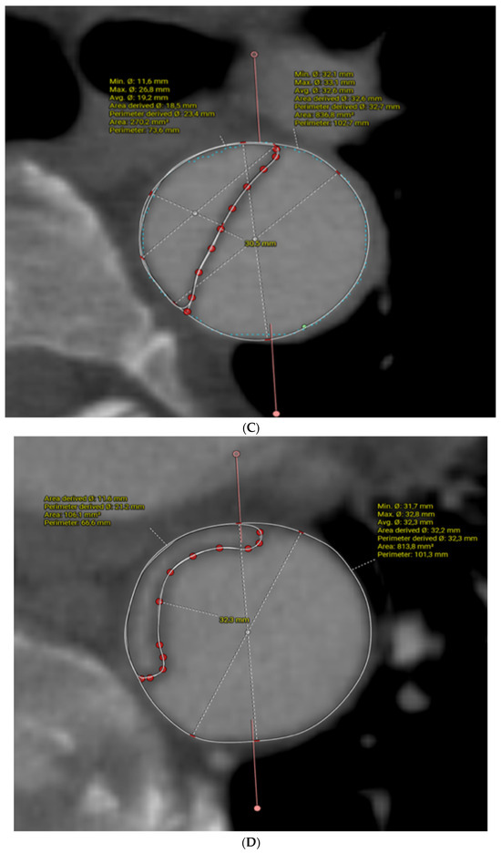 Sizing the Frozen Elephant Trunk Based on Aortic Pathology and the ...