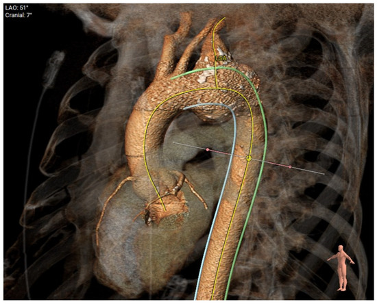 Sizing the Frozen Elephant Trunk Based on Aortic Pathology and the ...