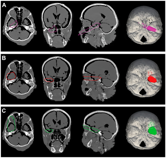 Quantitative Anatomical Comparison of Surgical Approaches to Meckel’s Cave