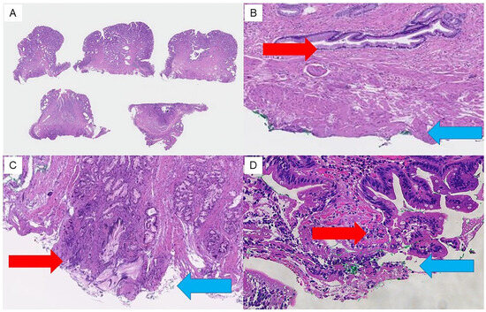 The Significance of Histopathological Findings on Clinical Outcomes in ...
