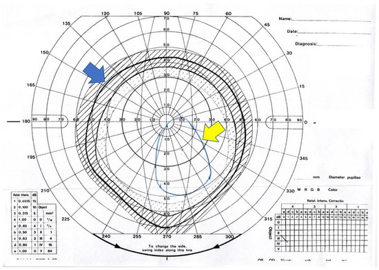 Surgical Outcomes of Bilateral Inferior Rectus Muscle Recession for ...