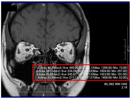 Surgical Outcomes of Bilateral Inferior Rectus Muscle Recession for ...