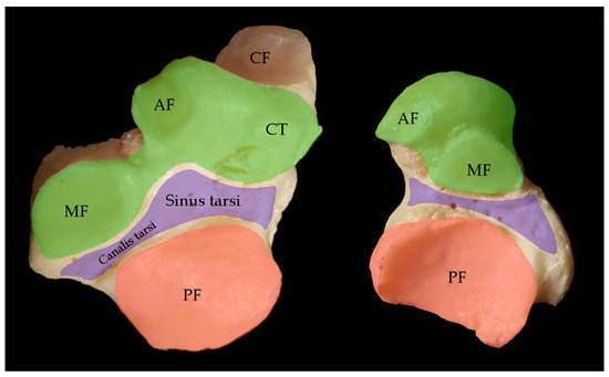 The Evolution of Sinus Tarsi Syndrome—What Is the Underlying Pathology ...