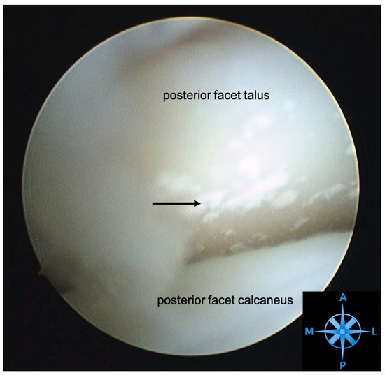 The Evolution of Sinus Tarsi Syndrome—What Is the Underlying Pathology ...