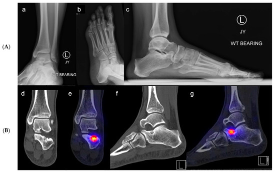 The Evolution of Sinus Tarsi Syndrome—What Is the Underlying Pathology ...