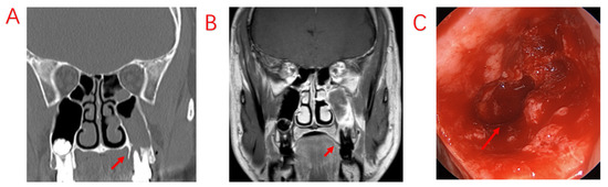 Endo-Periodontal Lesions—An Overlooked Etiology of Odontogenic Sinusitis