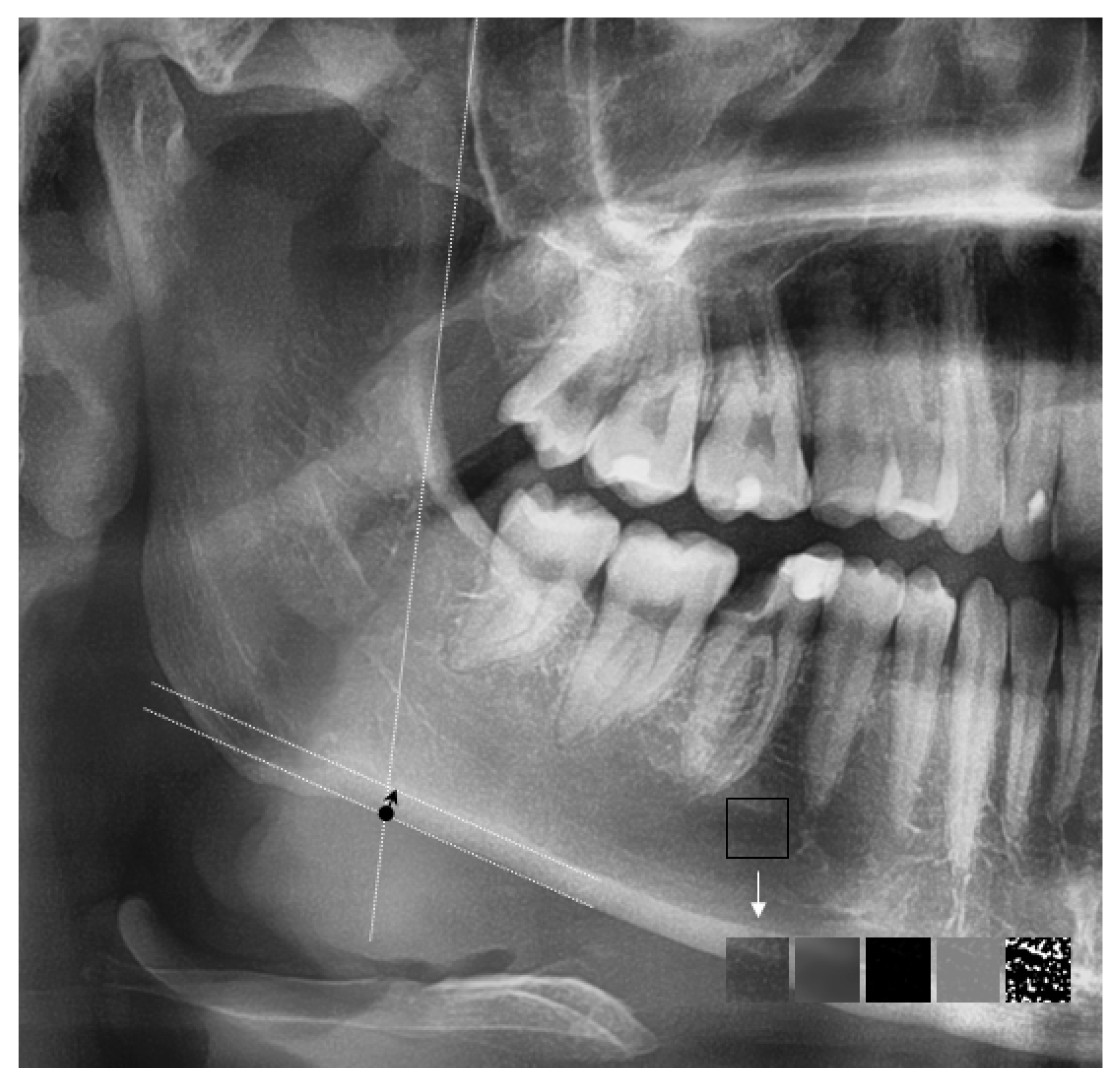 A Panoramic X-ray as a Supportive Diagnostic Tool for the Screening of Osteoporosis in Patients ...