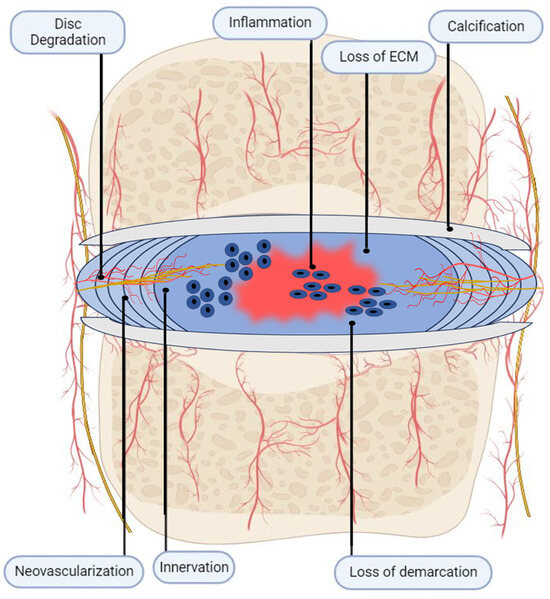 Updates on Pathophysiology of Discogenic Back Pain