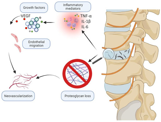 Updates on Pathophysiology of Discogenic Back Pain