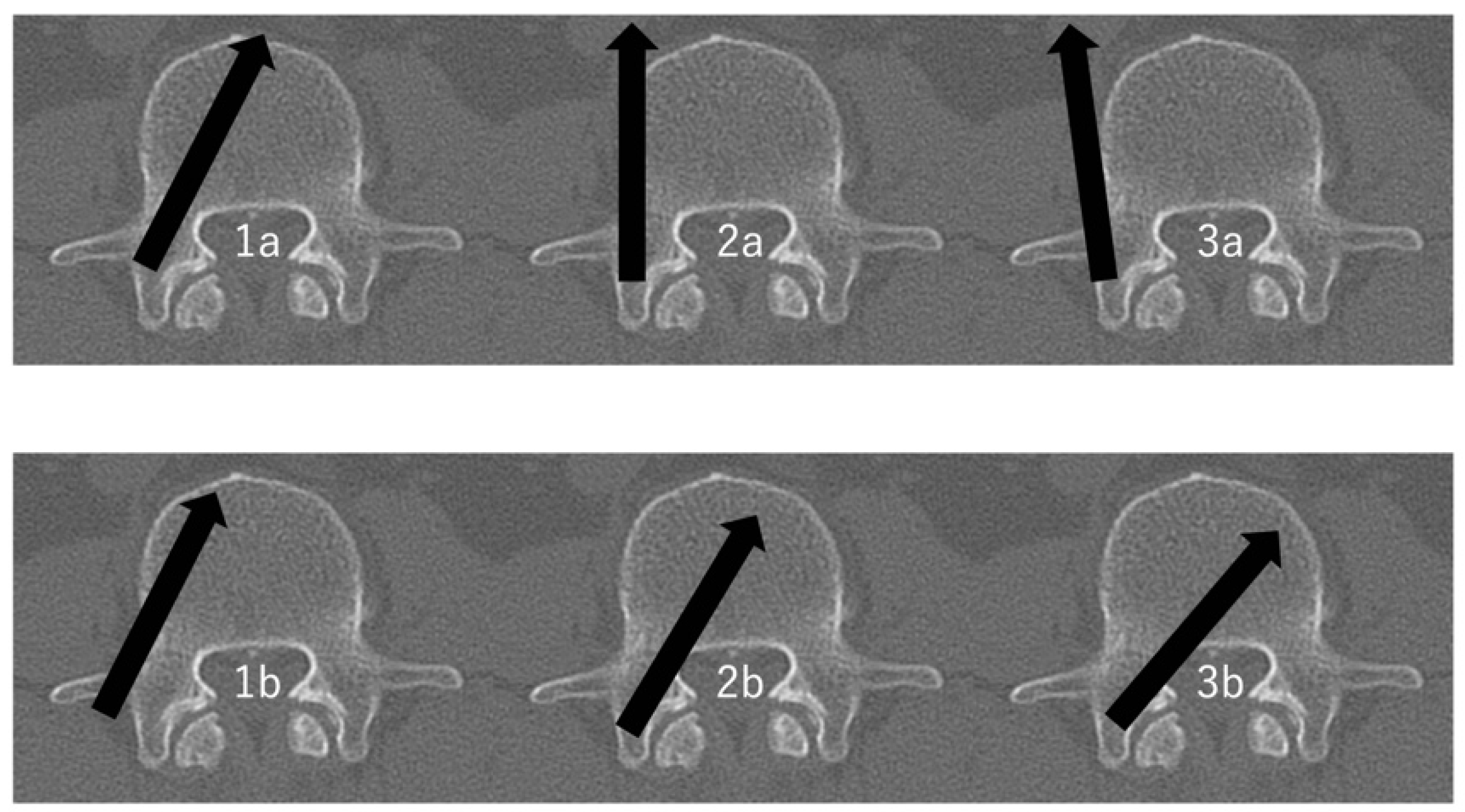 Jcm Free Full Text Assessing Procedural Accuracy In Lateral Spine
